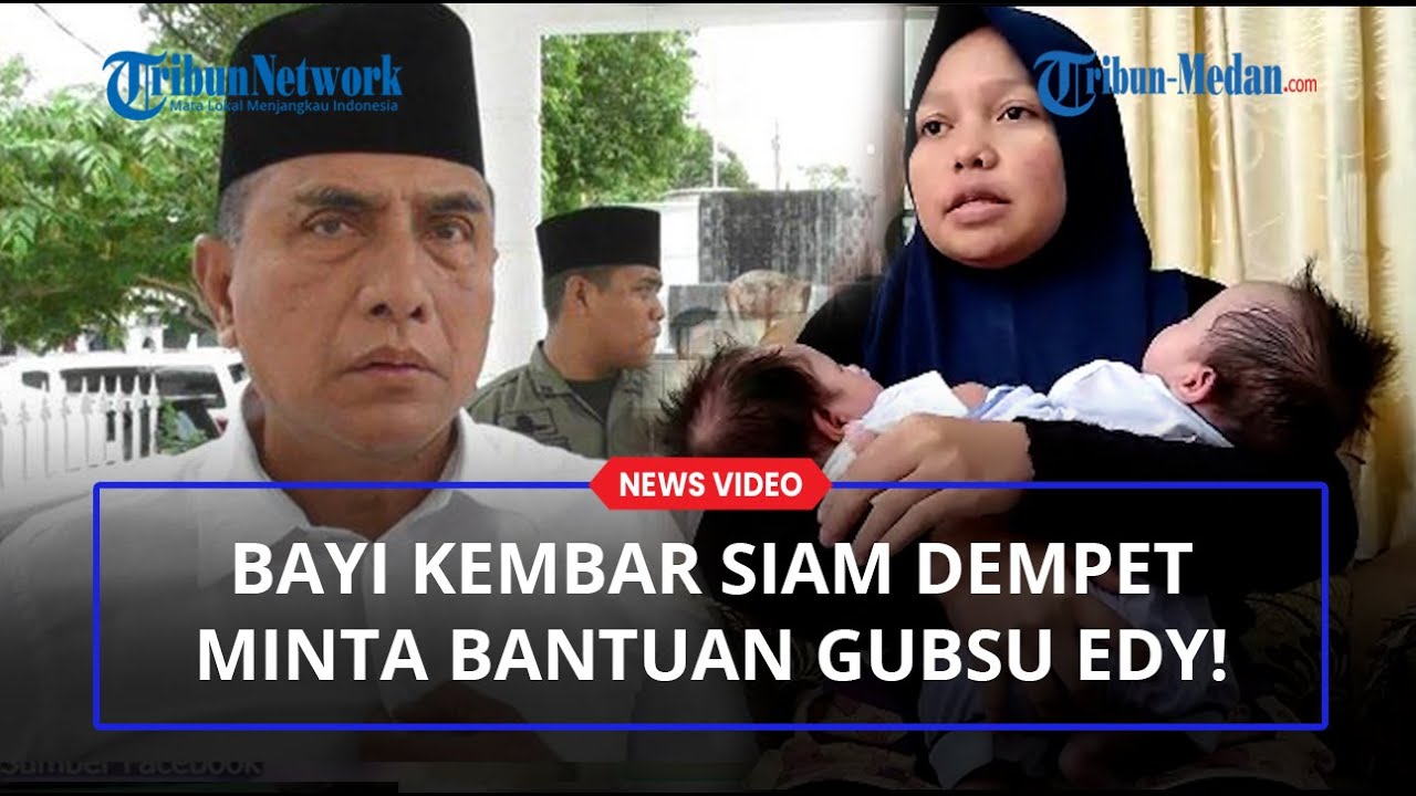 Bayi Kembar Siam Dempet Perut di Percut Sei Tuan Butuh Bantuan Gubsu ...