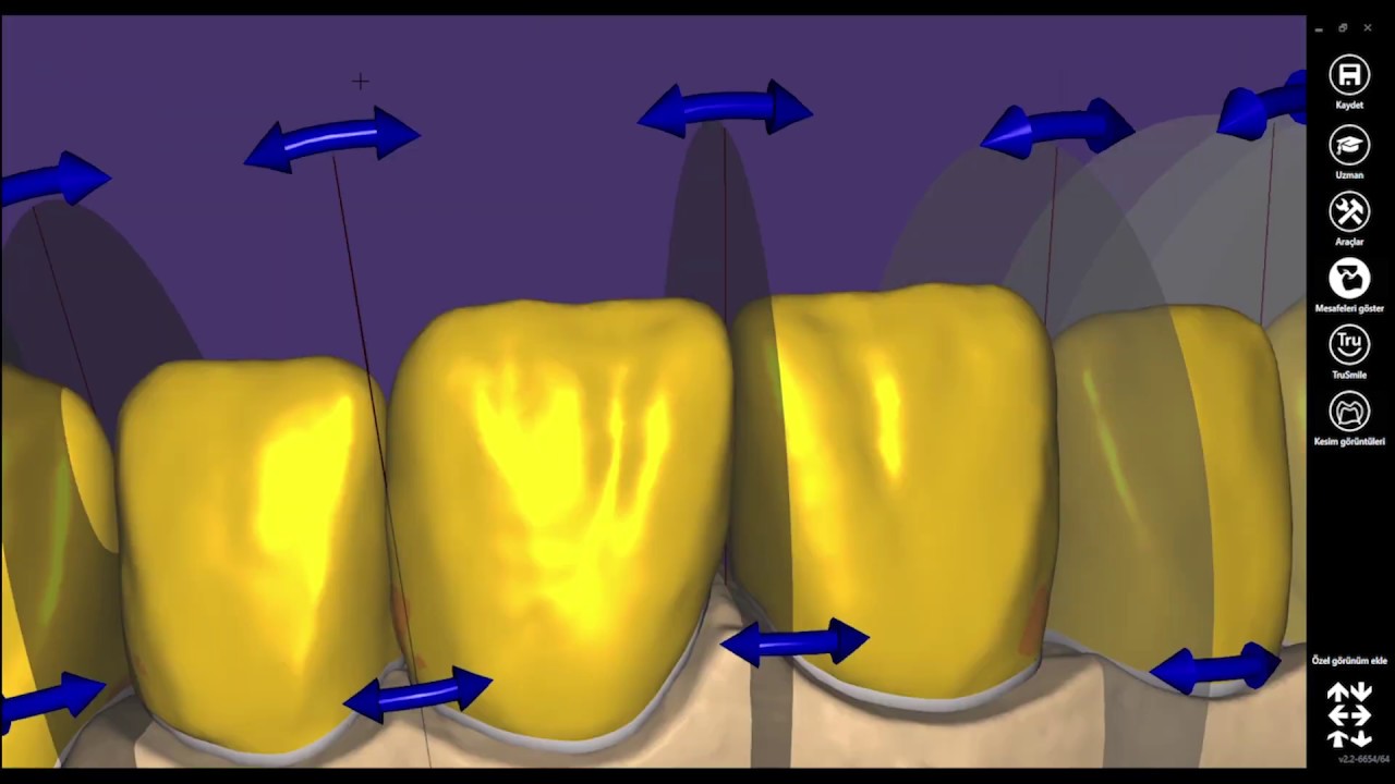 exocad design - YouTube