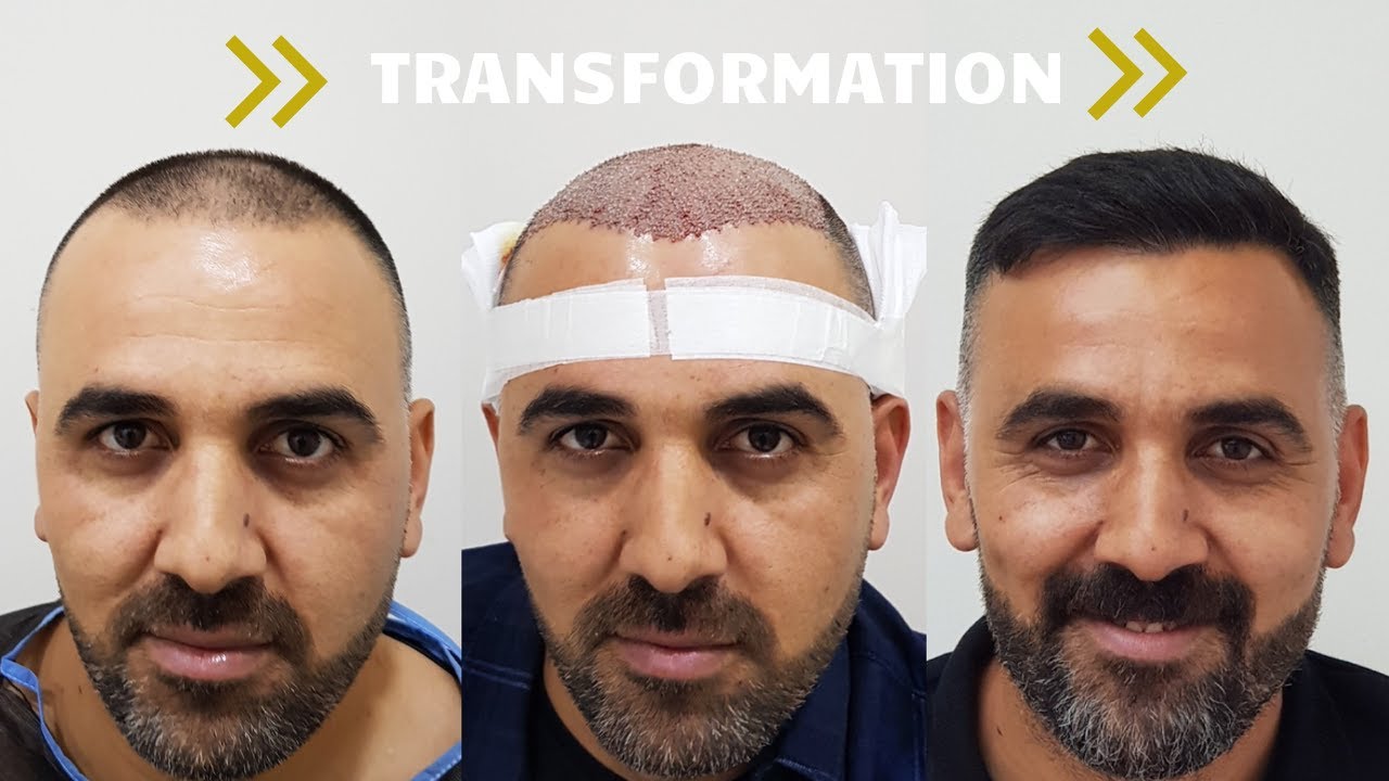 Micro FUE Hair Transplant in Turkey 2020: Before and After 4480 Grafts ...