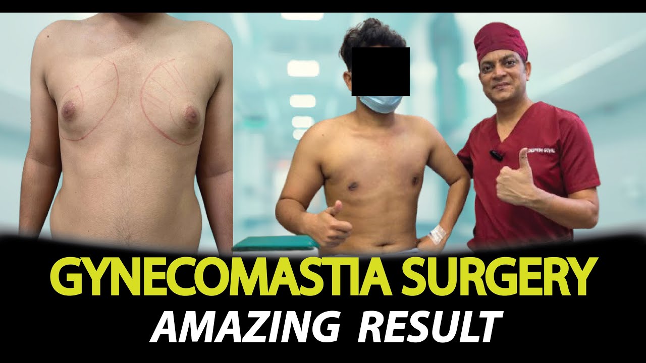 Gynecomastia Treatment in Jaipur | Male Chest Reduction Surgery | Dr. Deepesh Goyal - YouTube