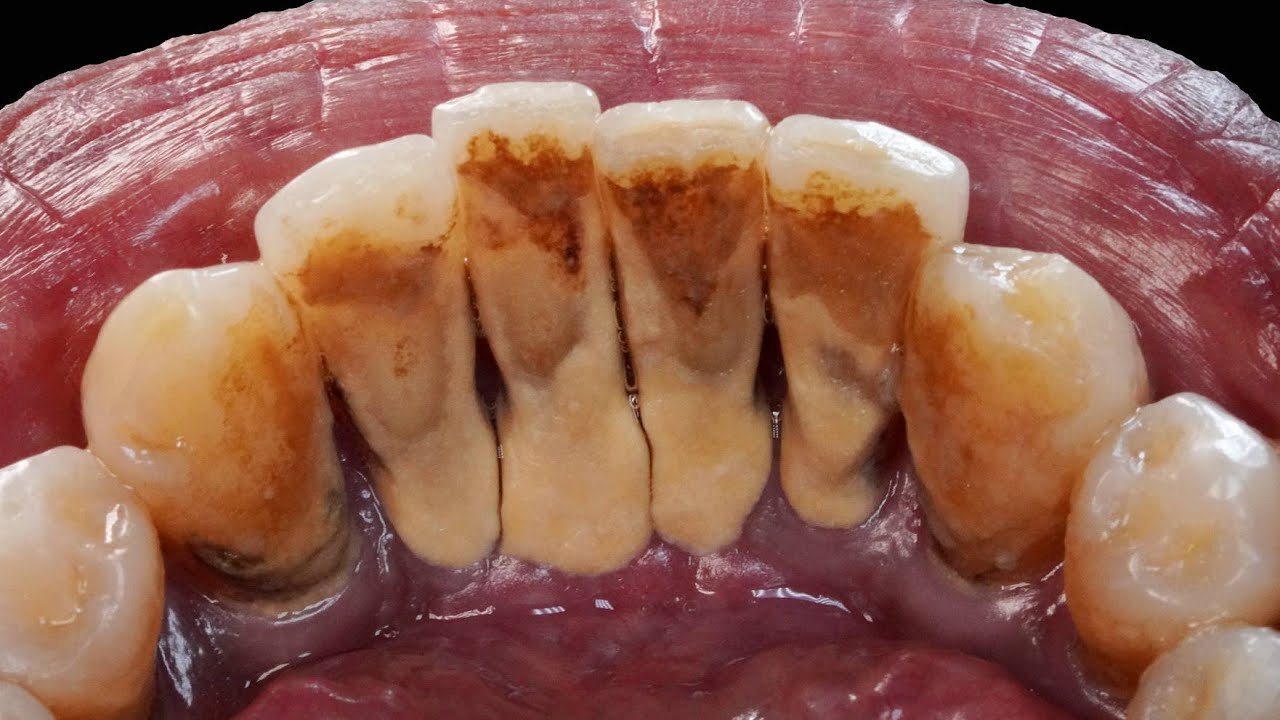 45yo Male. SCALING TARTAR | Dentist | Dokter Gigi Tri Putra - YouTube