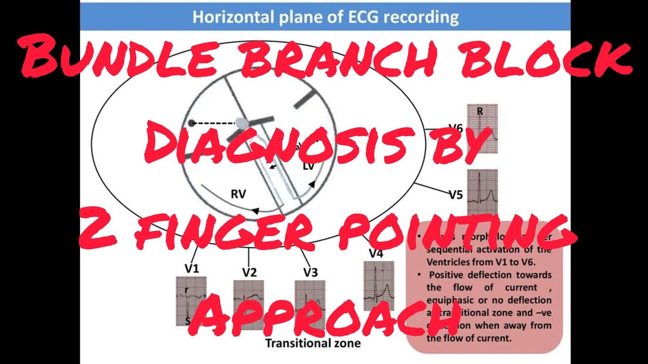 Diagnosis of Bundle branch block by two finger pointing approach by Dr ...