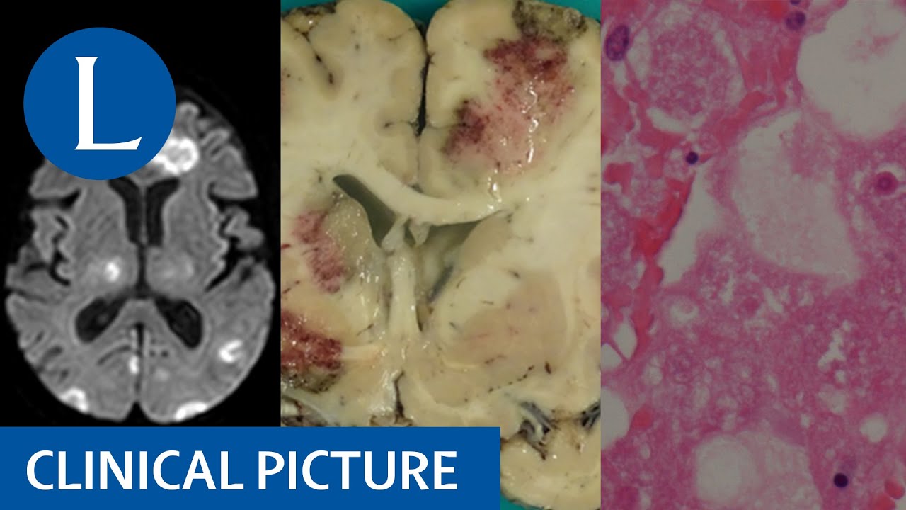 A rare cause of left-sided weakness in an elderly woman - YouTube