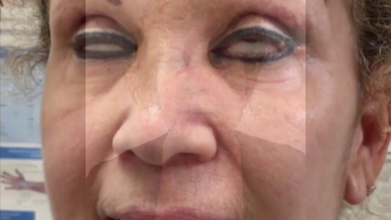 Síndrome de Meige - YouTube