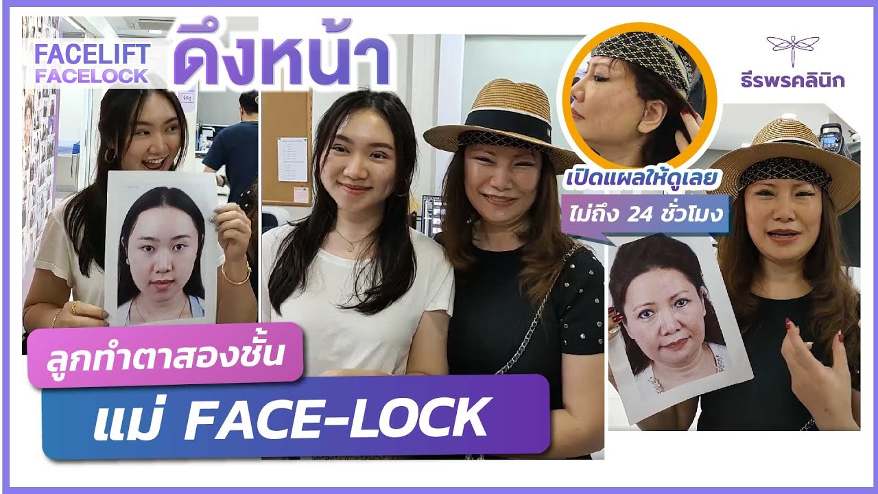 สาวปักกิ่ง ดึงหน้า Face-Lock ทำไม่ถึง 24 ชั่วโมง พร้อมลูกสาวทำตาสองชั้น ...