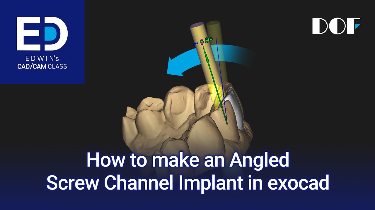 How to Make an Angled Screw Channel Implant in exocad - YouTube