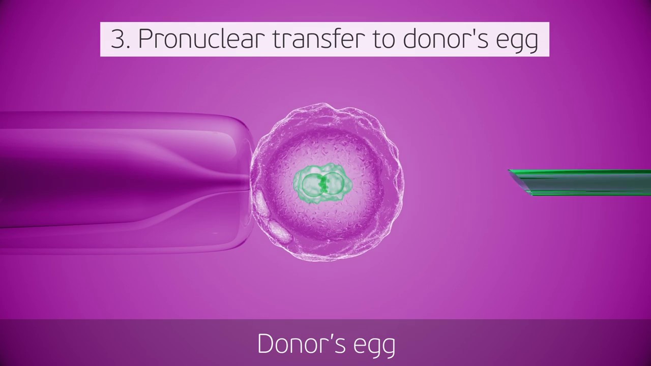 Pronuclear Transfer by Nadiya Clinic - YouTube