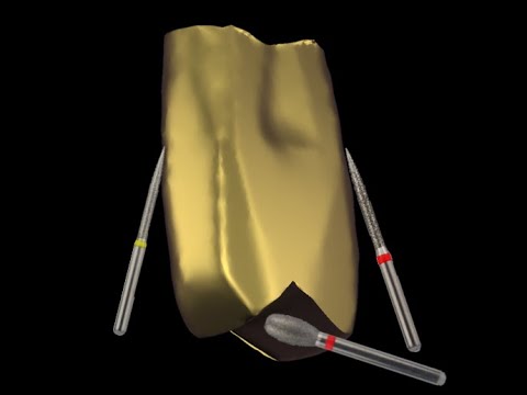 Vertical preparation 1.5 - YouTube