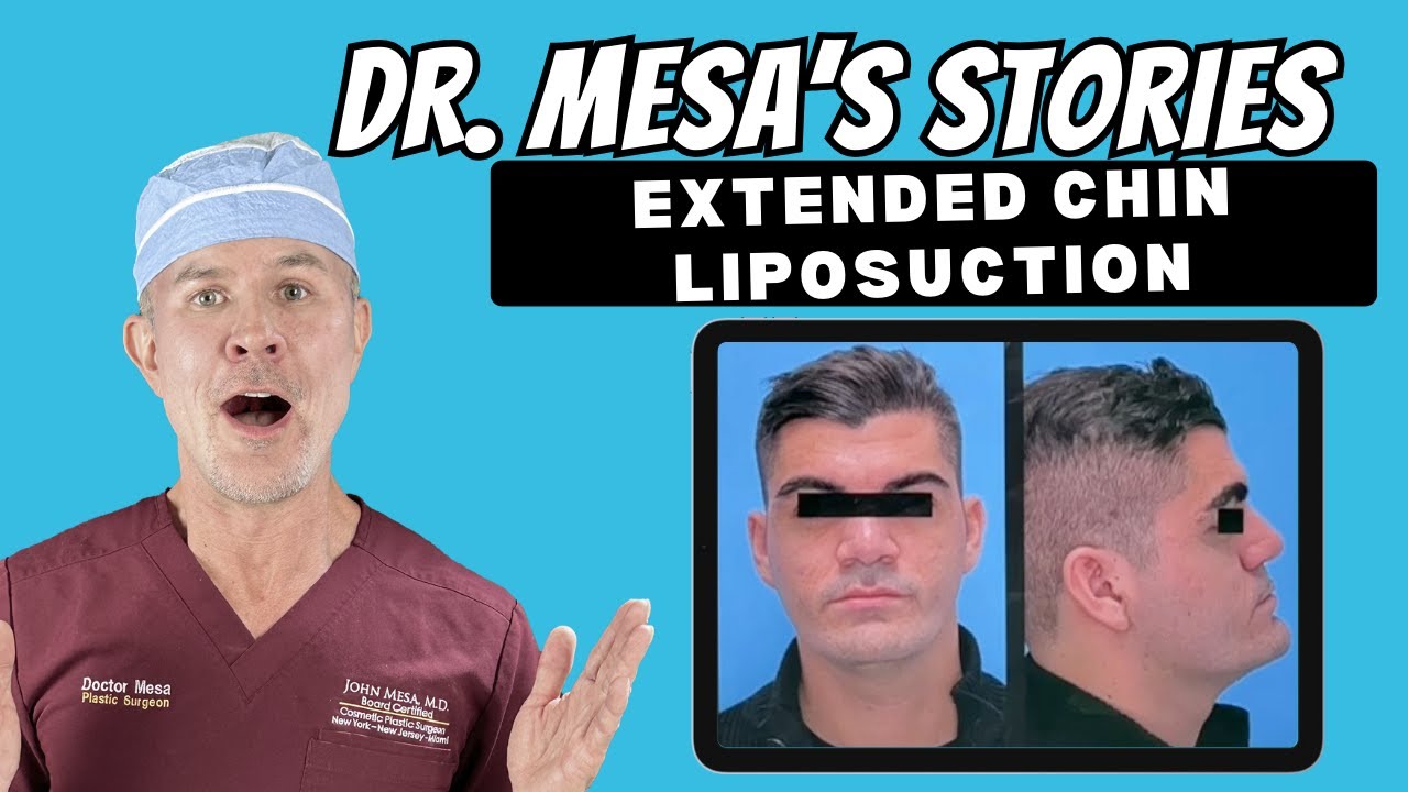 Dr. Mesa's Story 12: Extended Chin Liposuction - YouTube