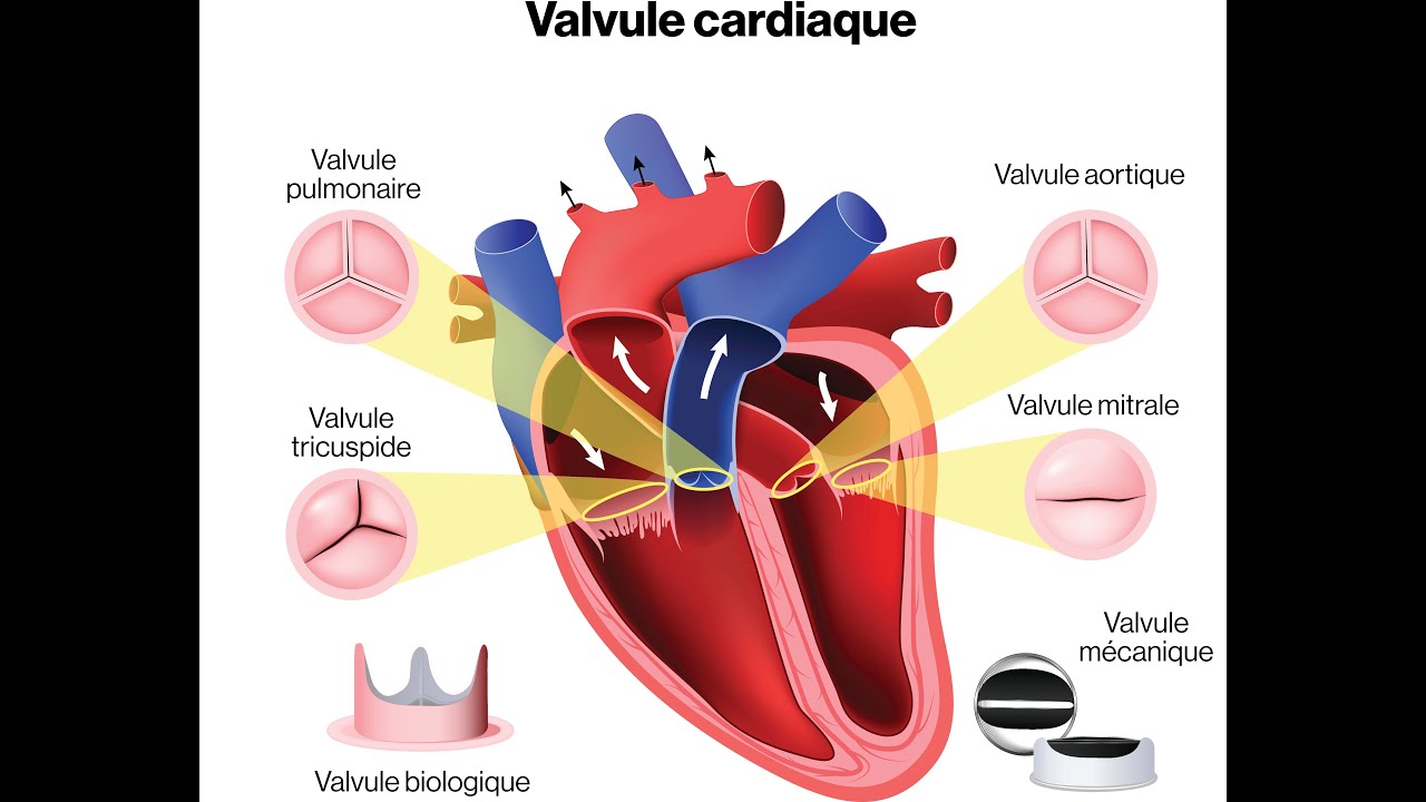 Chirurgie cardiaque | Les prothèse valvulaires cardiaques - YouTube