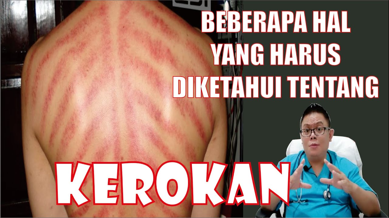 Beberapa Hal Penting Tentang Kerokan Youtube