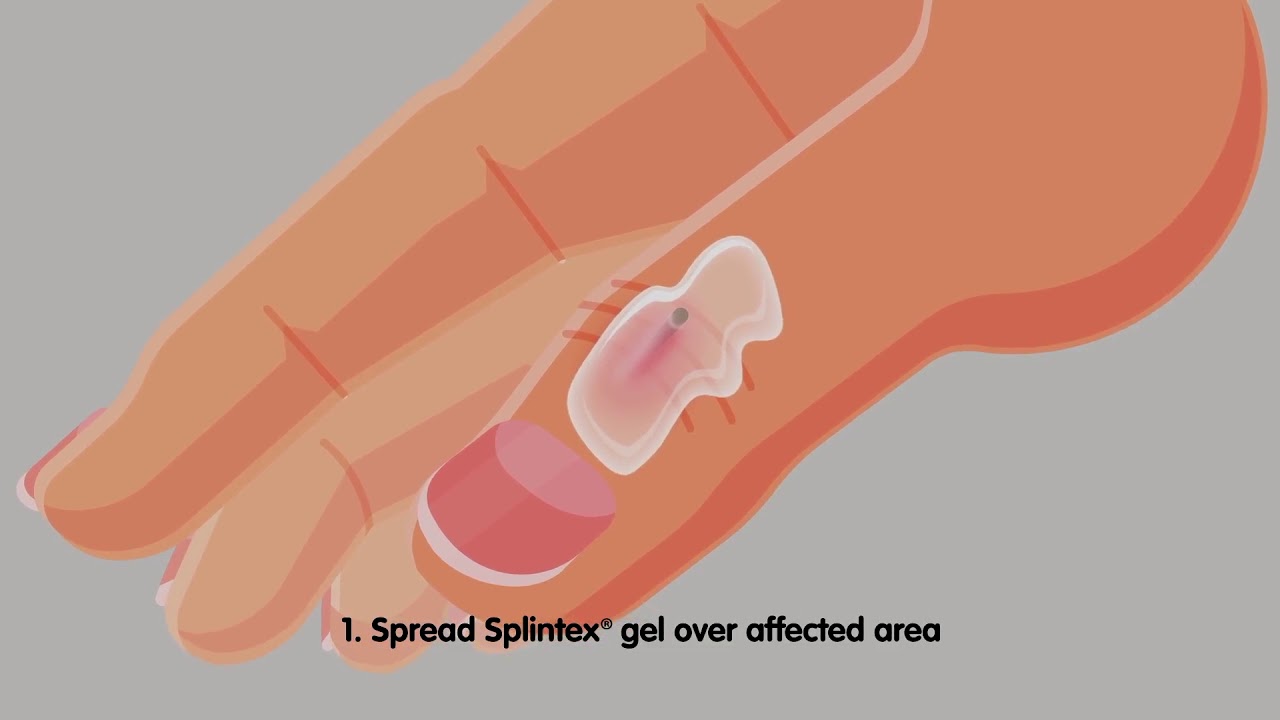 How Magnoplasm Splintex Works - Pain-free, fuss-free splinter removal - YouTube