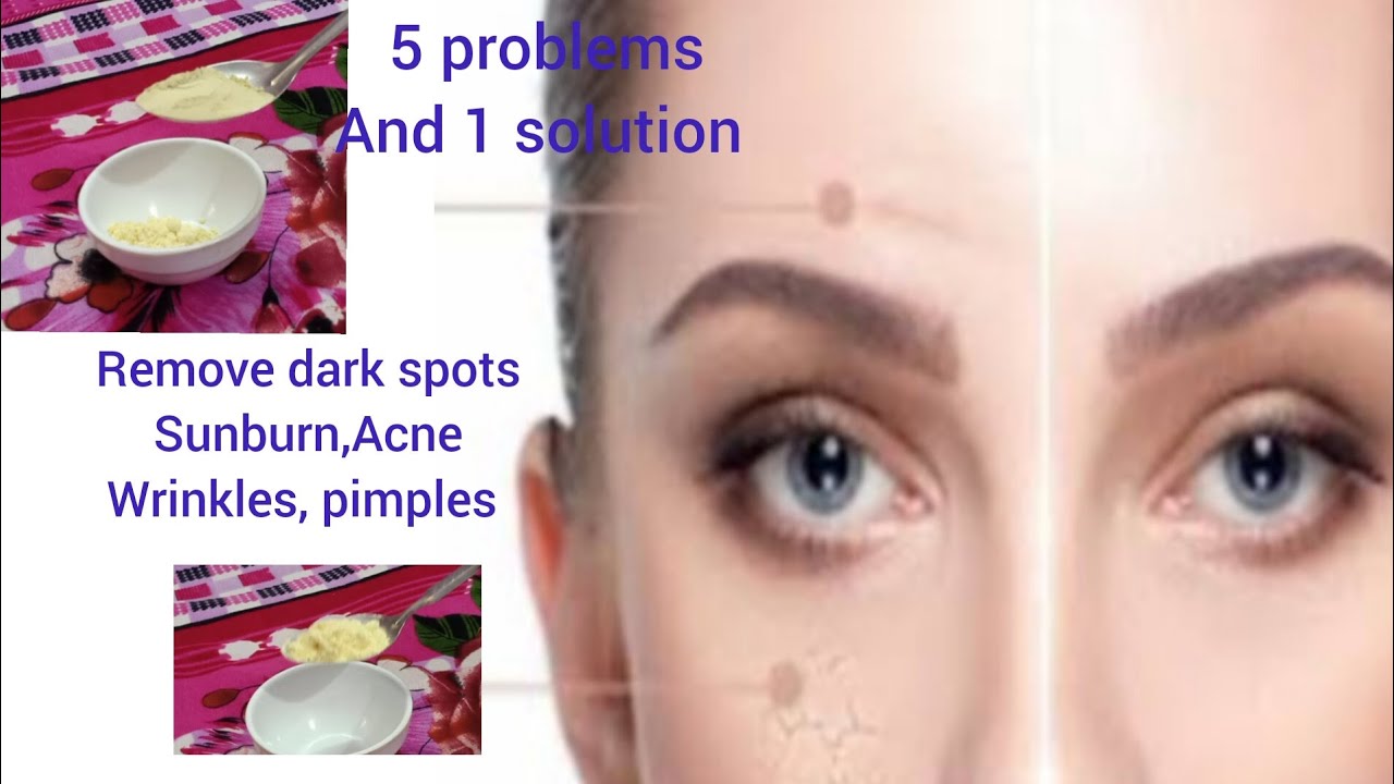 5 problems and 1solution. remove dark spots,acne, wrinkles, pimple and ...