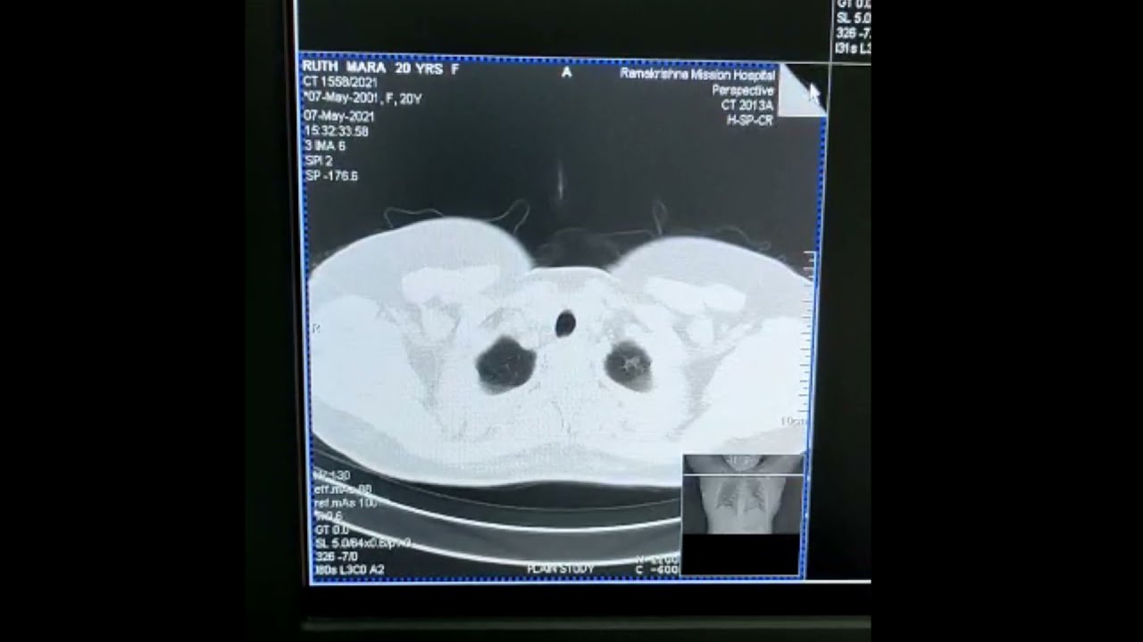COVID PATIENT CT SCAN CT SCAN REPORT KAISE DEKHE How To Read CT COVID PATIENT CT SCAN CT SCAN REPORT KAISE DEKHE How To Read CT