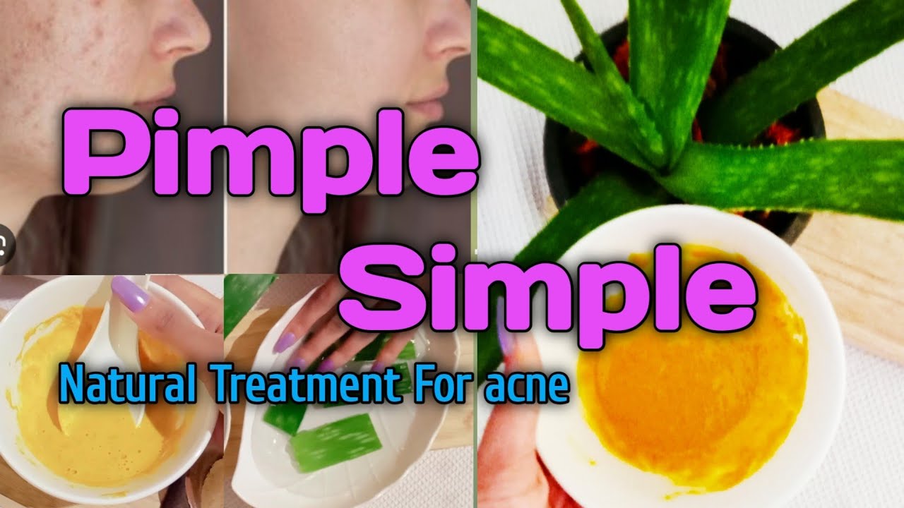 NATURAL TREATMENT FOR ACNE| To get rid of acne in two weeks at home👍 ...