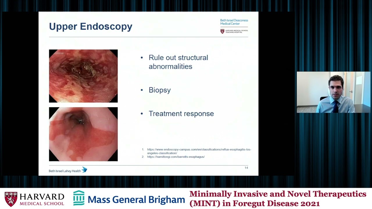 Interventions for reflux: minimally invasive anti reflux surgery - YouTube