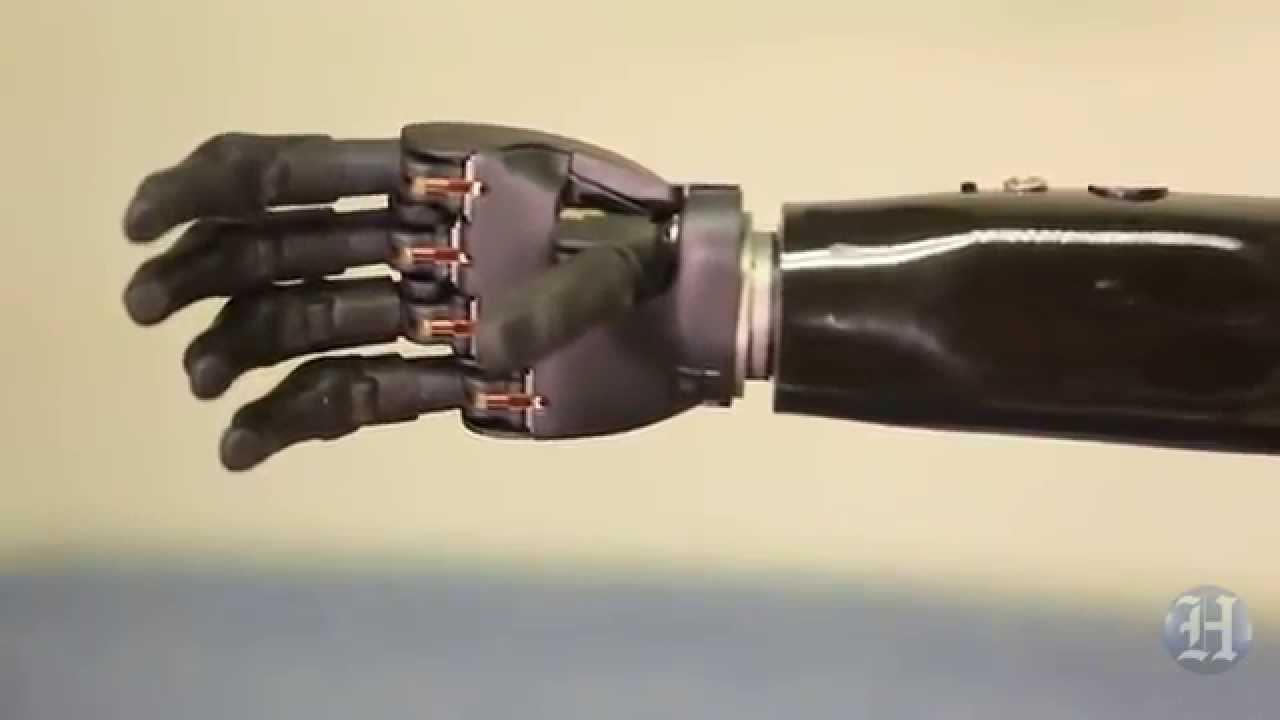 Florida woman gets high tech bionic arm - YouTube