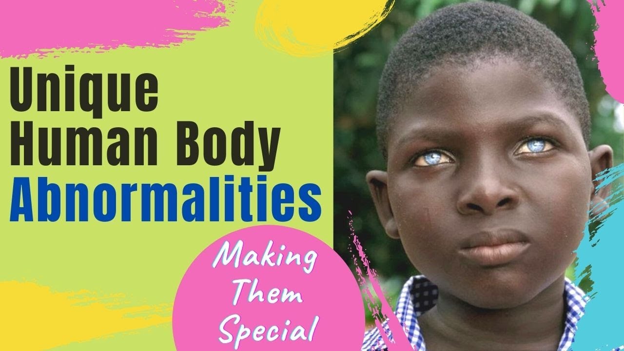 10 Unique Human Body Abnormalities Making Them Special | GigDe - YouTube
