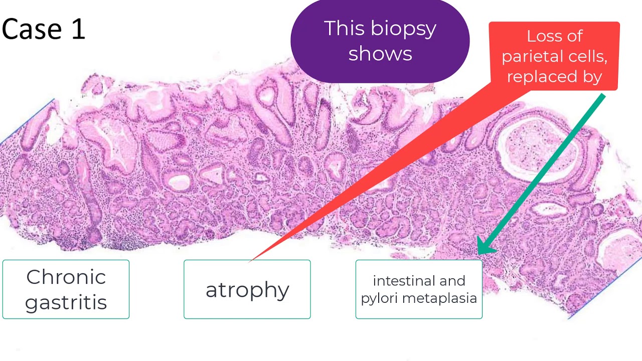 Atrophic Gastritis Pathology