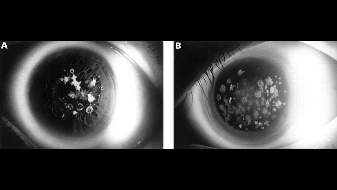 Guttata Or Corneal Guttata (tiny bumps on the corneal endothelium) ; Definition, causes ...