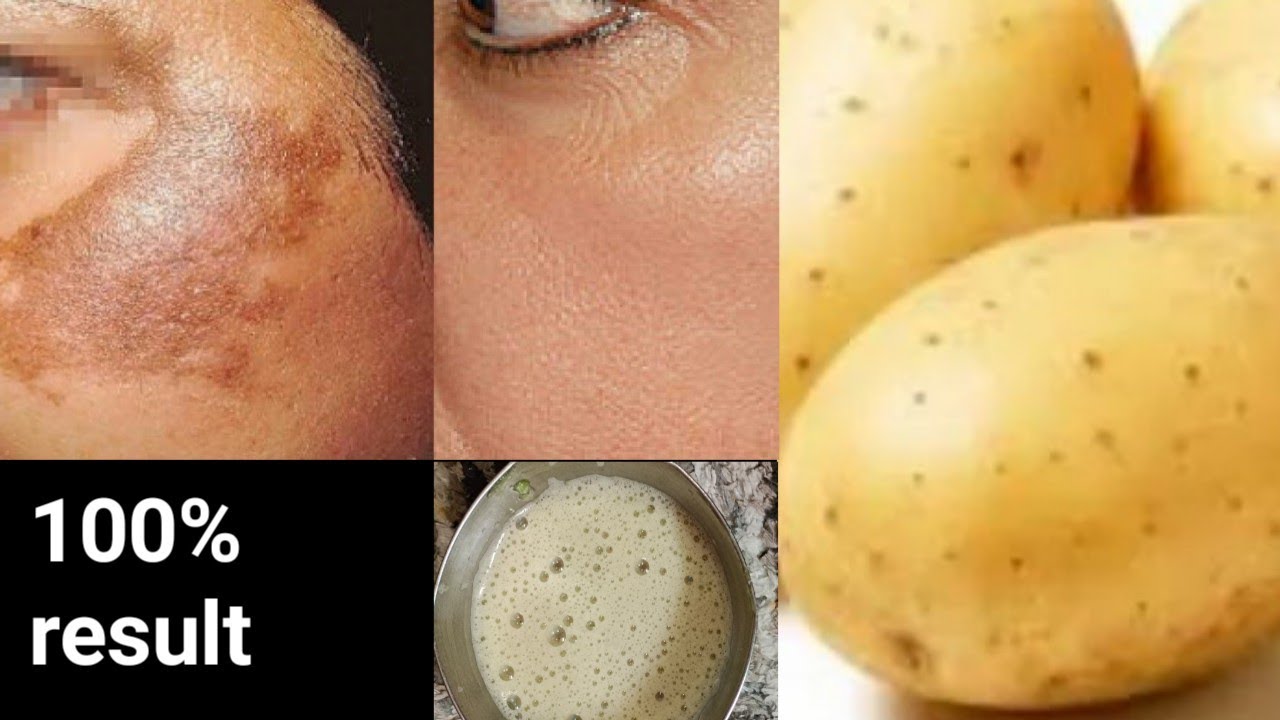 Effective DIY home remedy for Pigmentation dark spot and get glowing ...