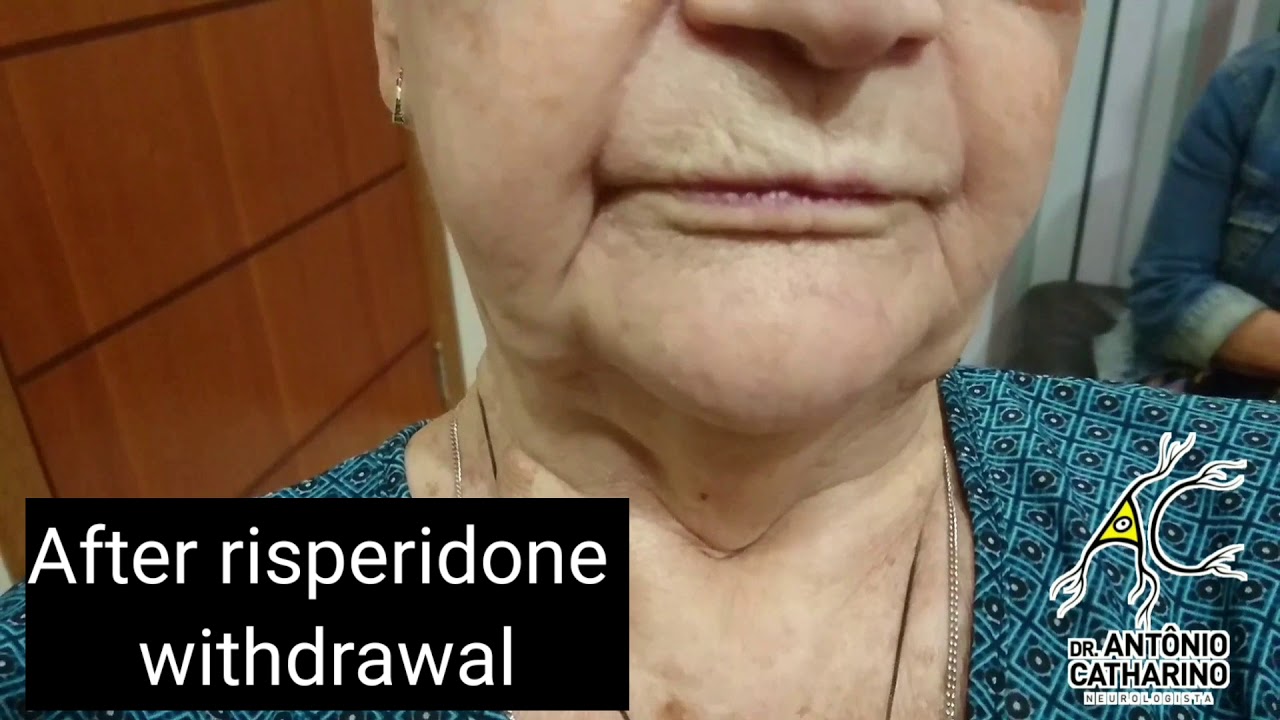 Risperidone-Induced Rabbit Syndrome: Video - Clinical Report - YouTube