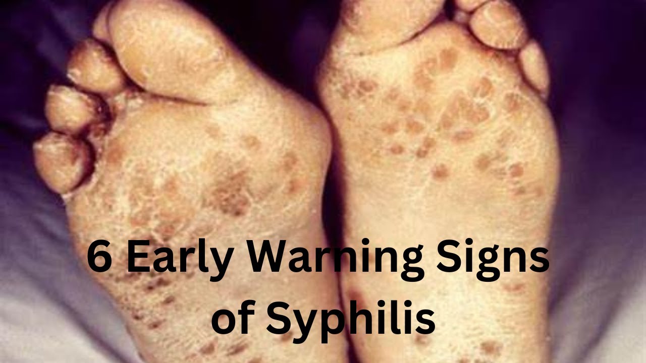 6 Early Warning Signs of Syphilis #health #fitness - YouTube