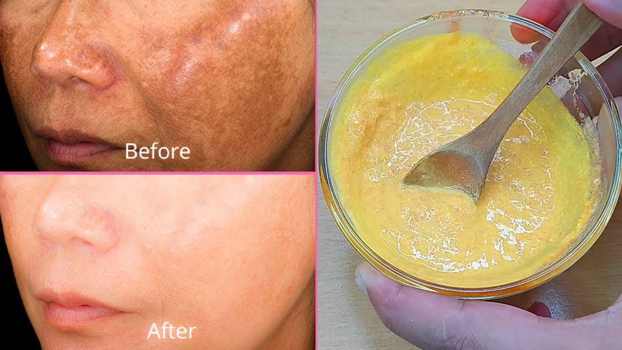 How to Get Rid of Pigmentation, Aging or Dark Spots - YouTube