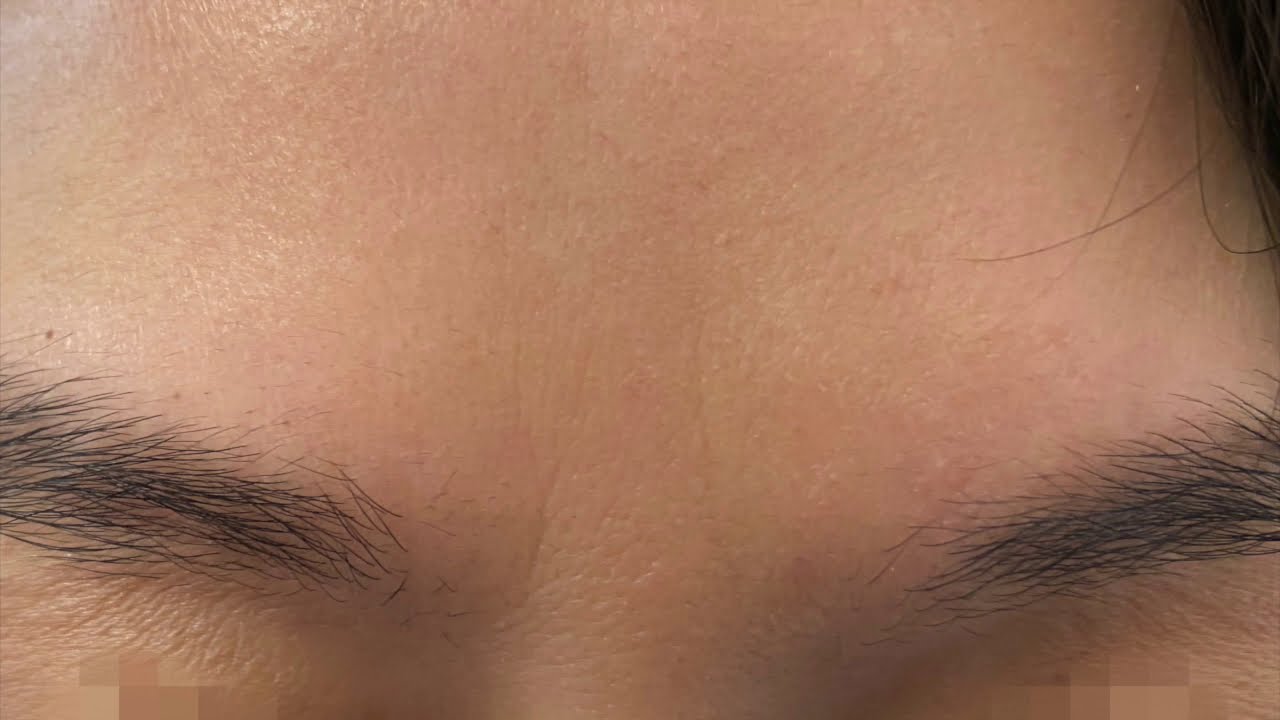 Glabella Case Studies - YouTube