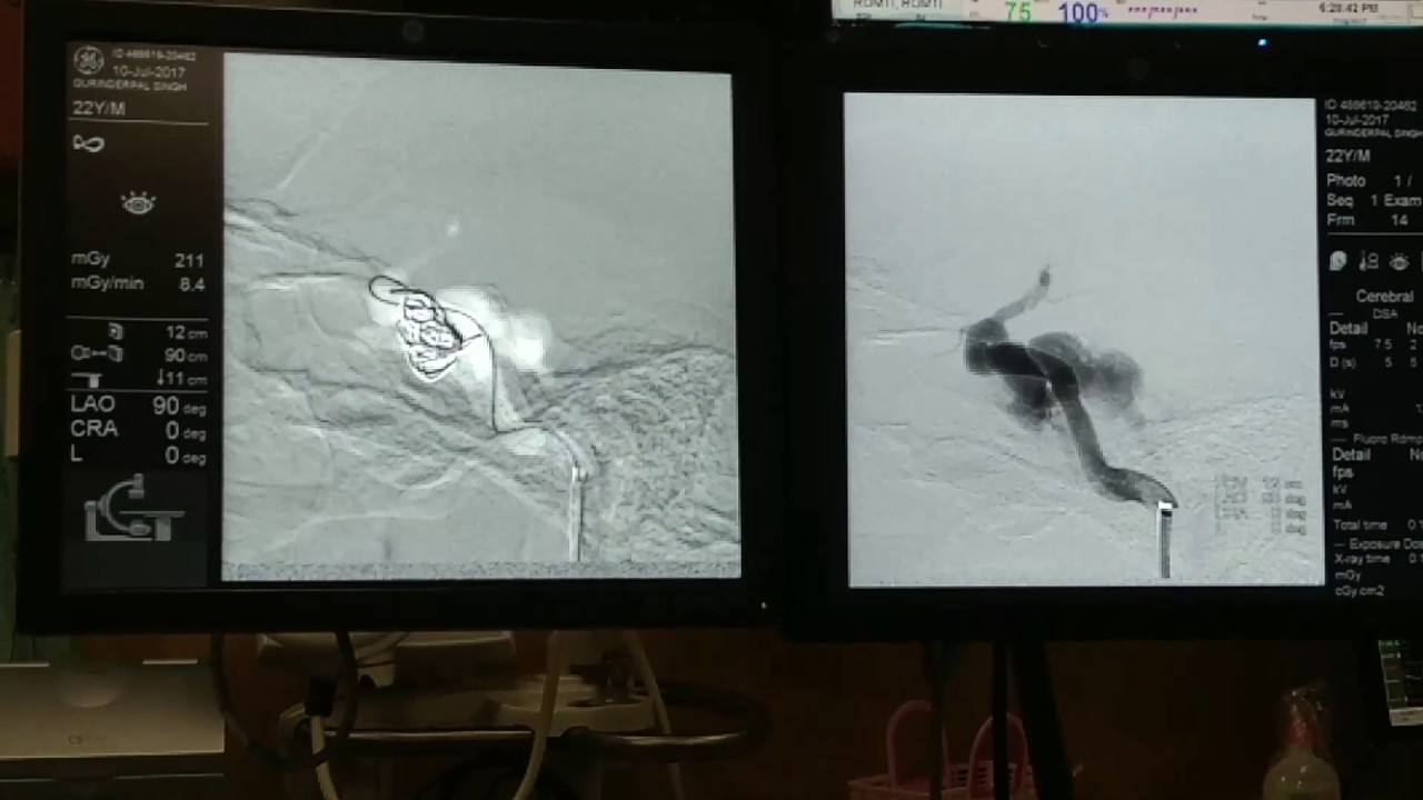 Direct Carotid Cavernous Fistula (CCF) embolization of large rent with ...