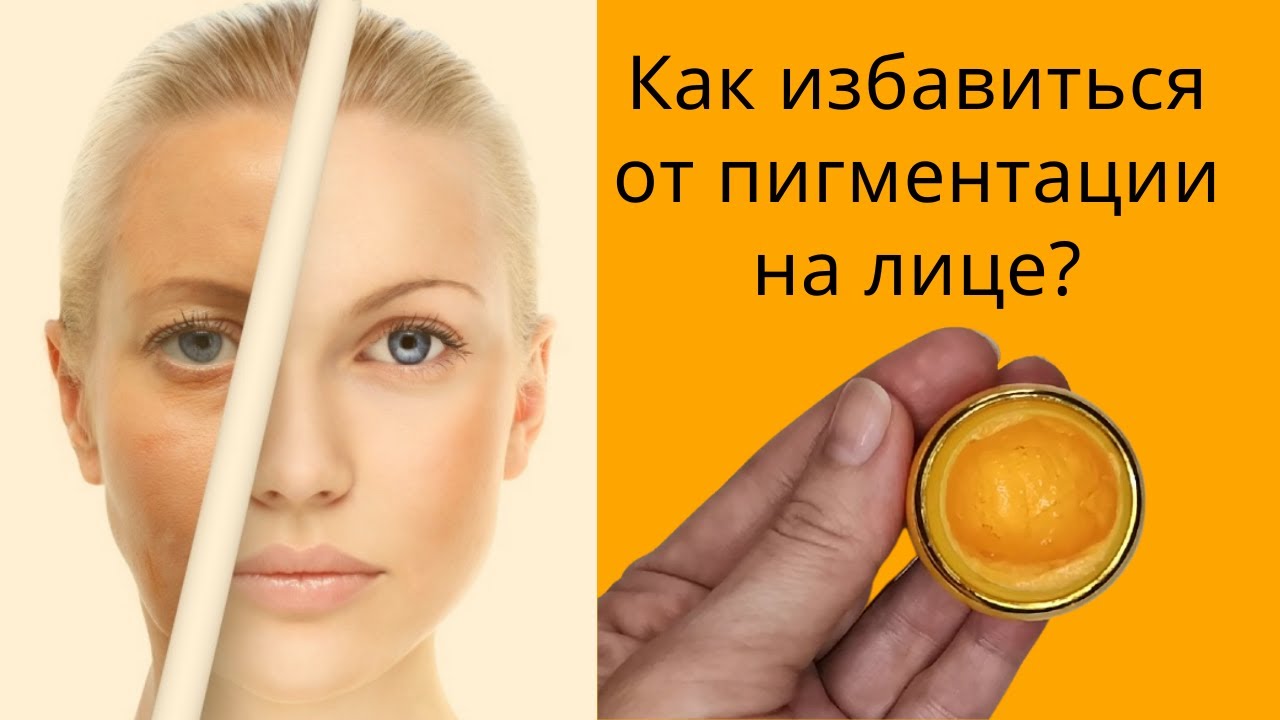 Пигментация на лице Как избавиться от пигментных пятен Как улучшить