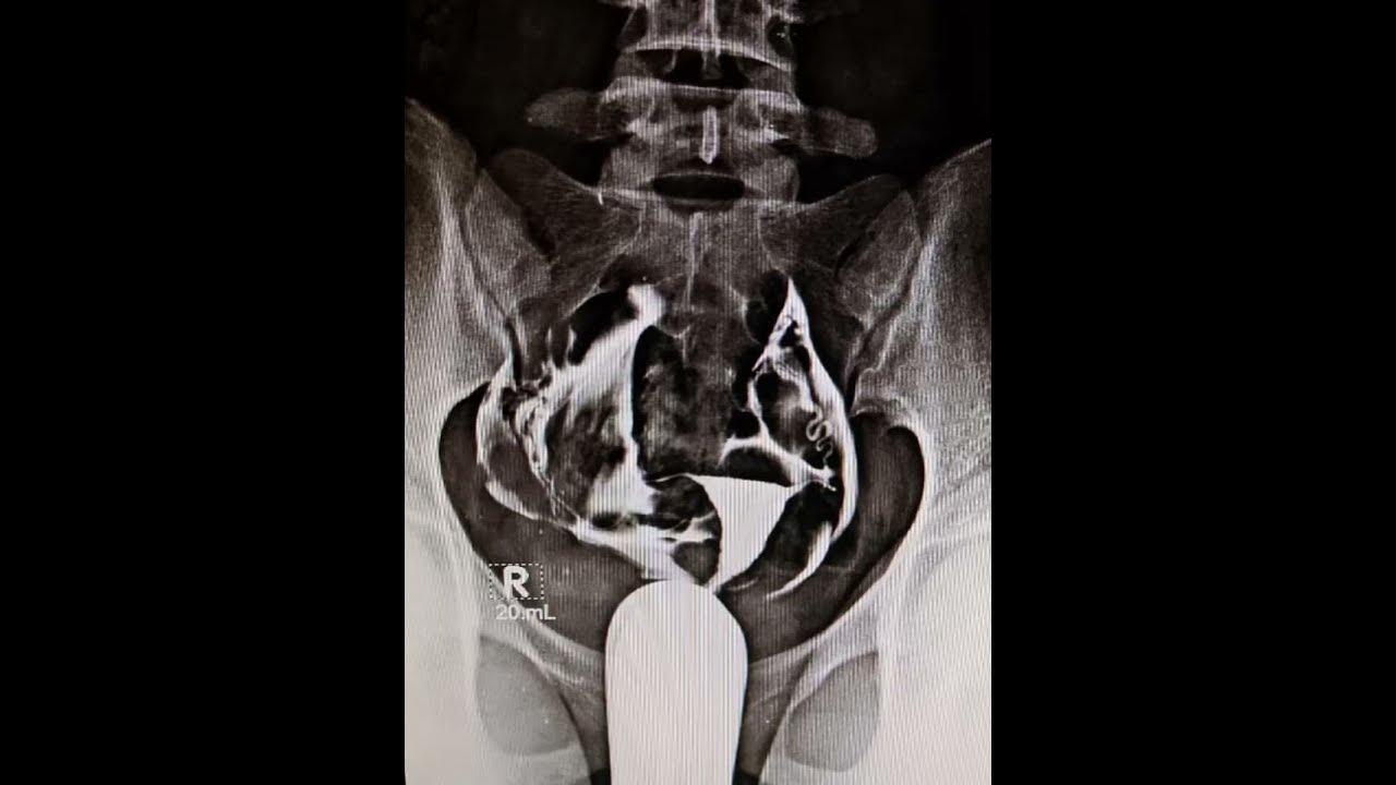 صور لحالة أشعة بالصبغة علي الرحم و الأنابيب Hysterosalpingography Hsg