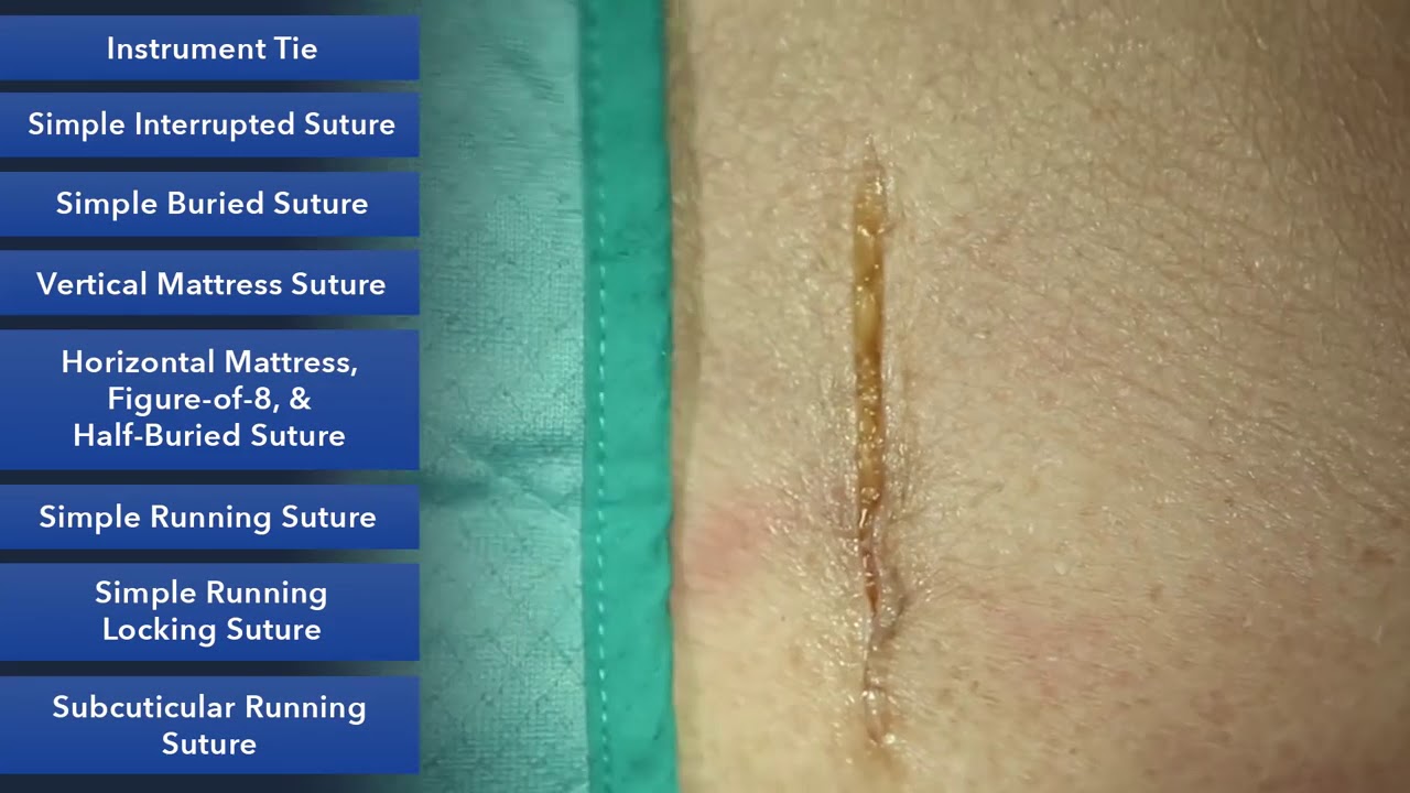 Subcuticular Running Suture Suture Techniques - YouTube