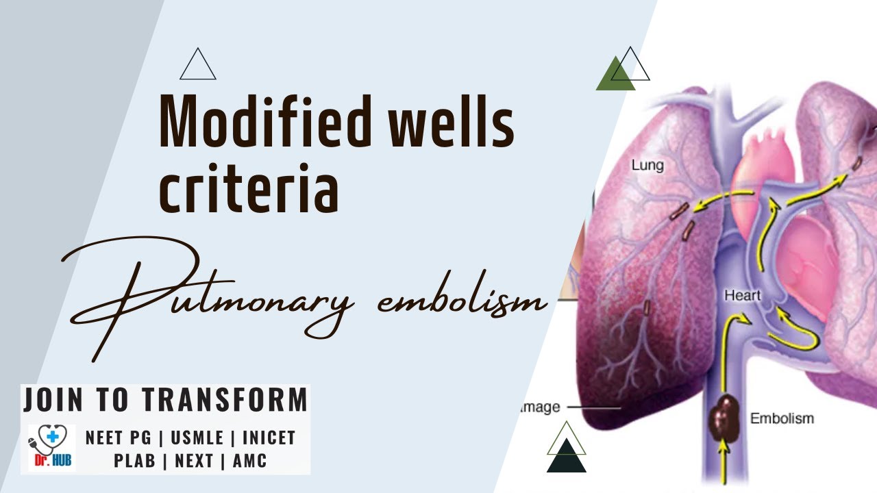 Modified wells criteria for pretext probability of Pulmonary embolism ...