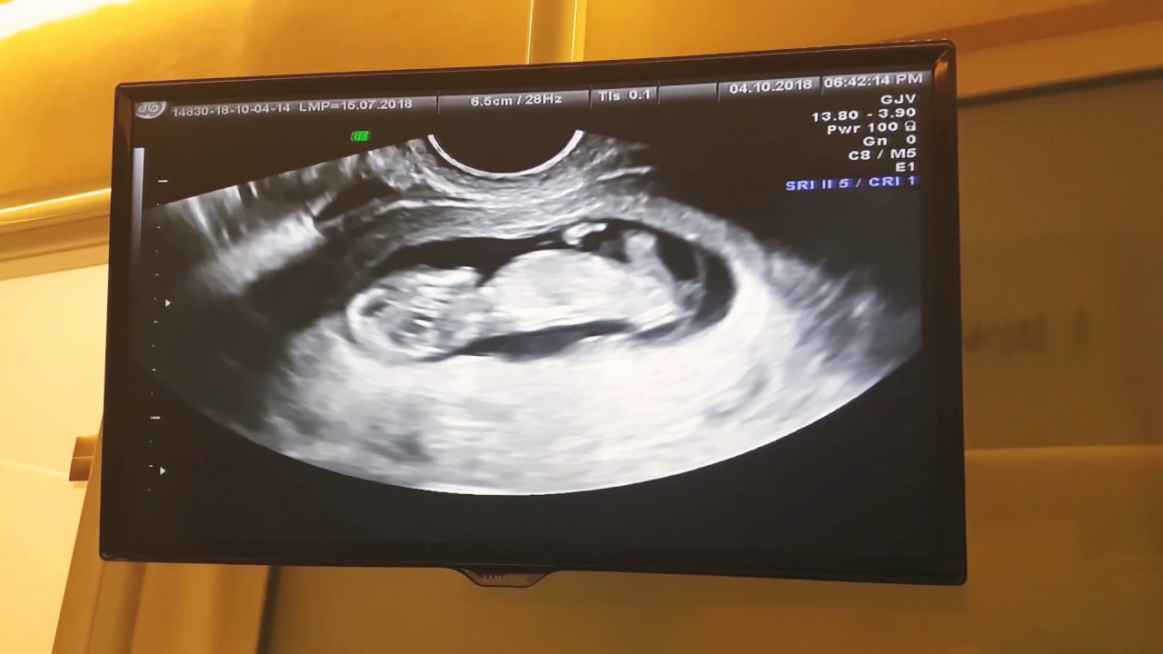 Υπερηχος 12 εβδομάδων / 12 weeks ultrasound - YouTube