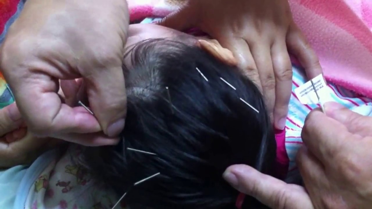 Scalp and Leg Acupuncture Cerebral Palsy - YouTube
