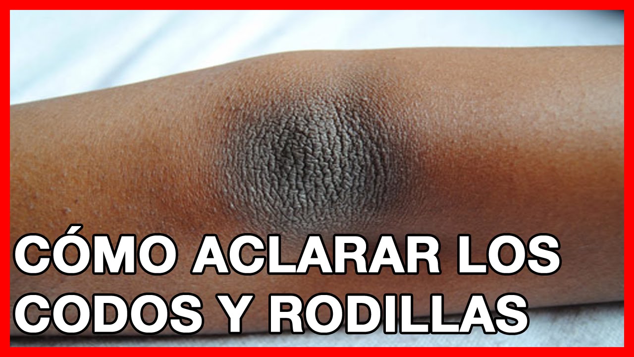 Cómo disminuir las manchas oscuras en los codos y rodillas - YouTube