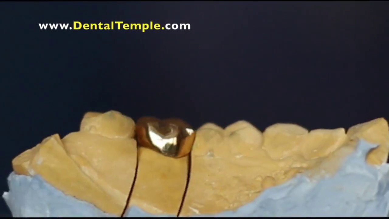 Metal crowns or metallic support for teeth are stronger and durable ...