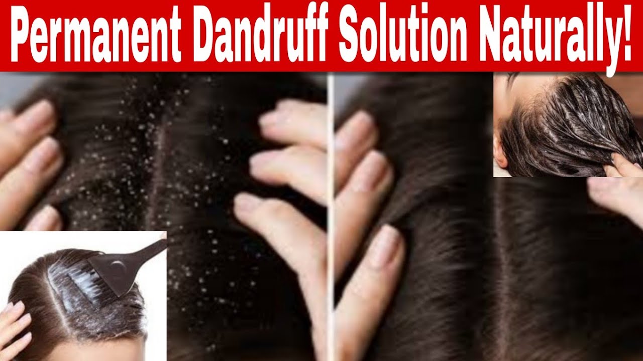 Best Remedies for Dandruff | How to Treat Dandruff at Home | Hair Care ...