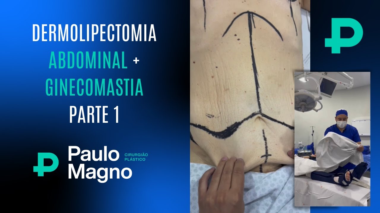Dermolipectomia abdominal + ginecomastia - PARTE 1 - YouTube