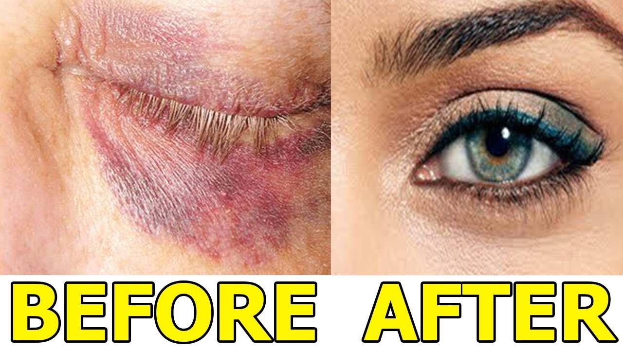 How To Get Rid Of A Black Eye Fast Top 5 Best Ways YouTube how-to-get-rid-of-a-black-eye-fast-top-5-best-ways-youtube