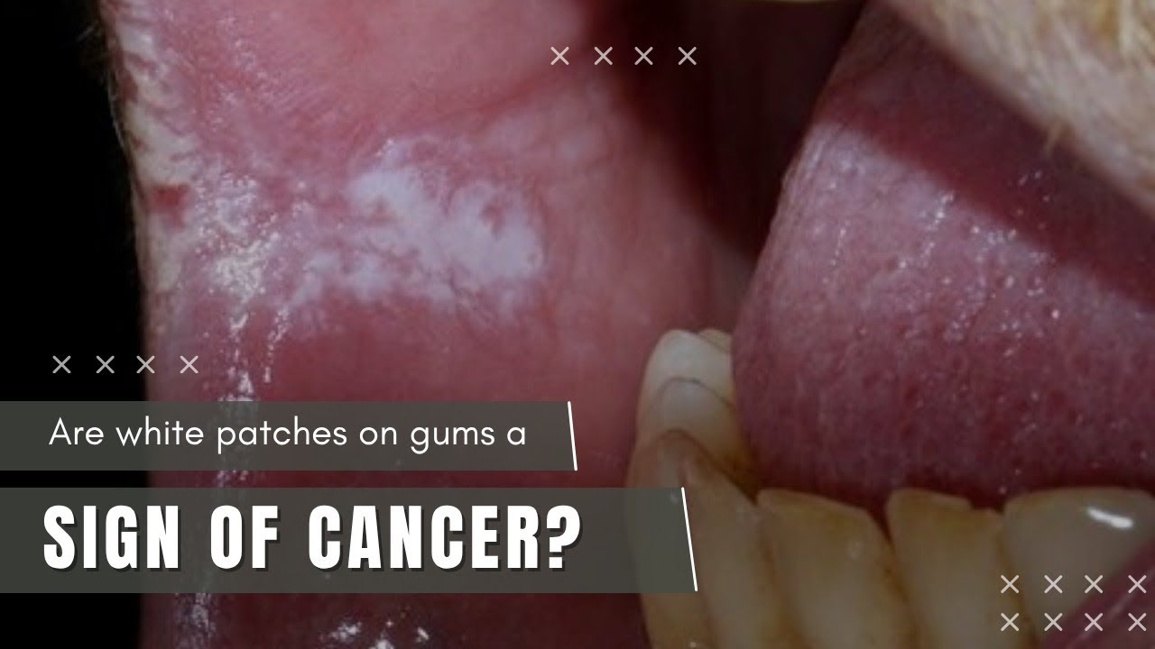 Are white patches on gums a sign of cancer? - YouTube