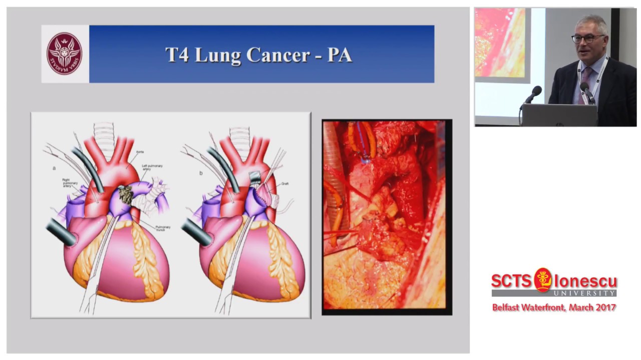 Surgery For T4 Tumors - YouTube