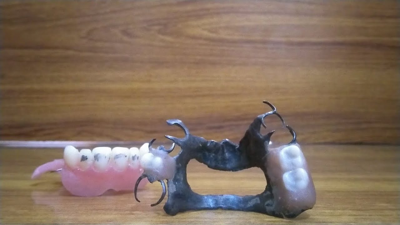 Prostho | RPD | Acrylic V Cast Partial Denture - YouTube