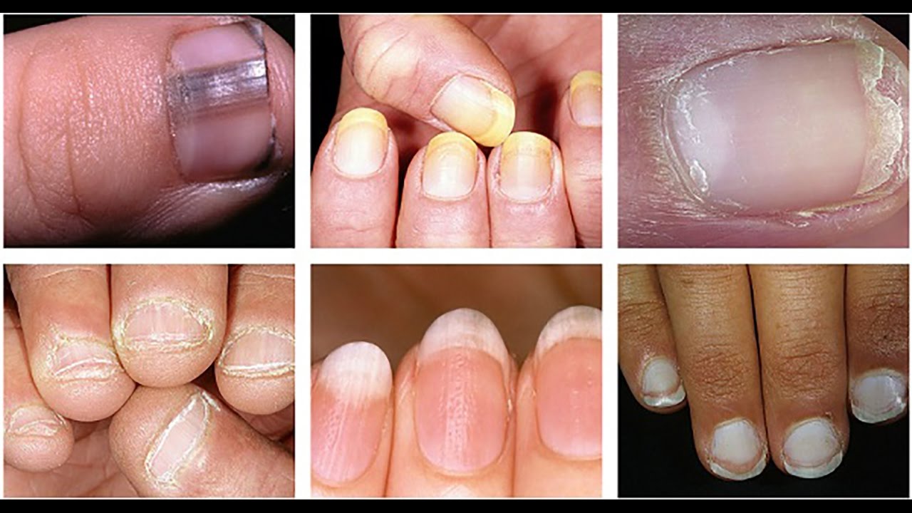 7 Characteristics Of Nails That Are Linked To Serious Health Problems 7-characteristics-of-nails-that-are-linked-to-serious-health-problems