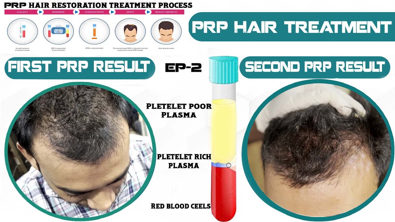 Prp Hairfall Hairloss Treatment Second Prp Result Afsaar Ansari - YouTube