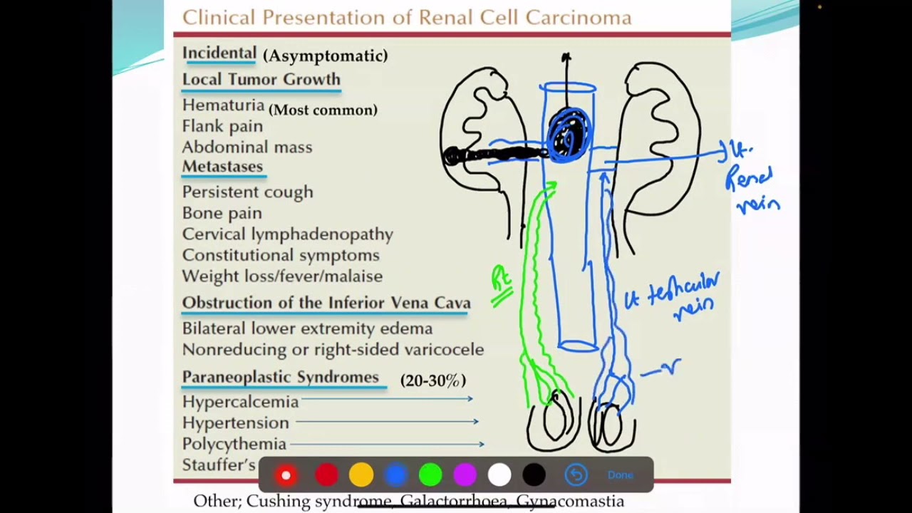 Renal cell carcinoma ( RCC part 2 ; Diagnosis— clinical features ...