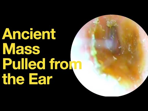 Ancient Mass Pulled from the Ear |ear wax removal | ear cleaning | ASMR ...