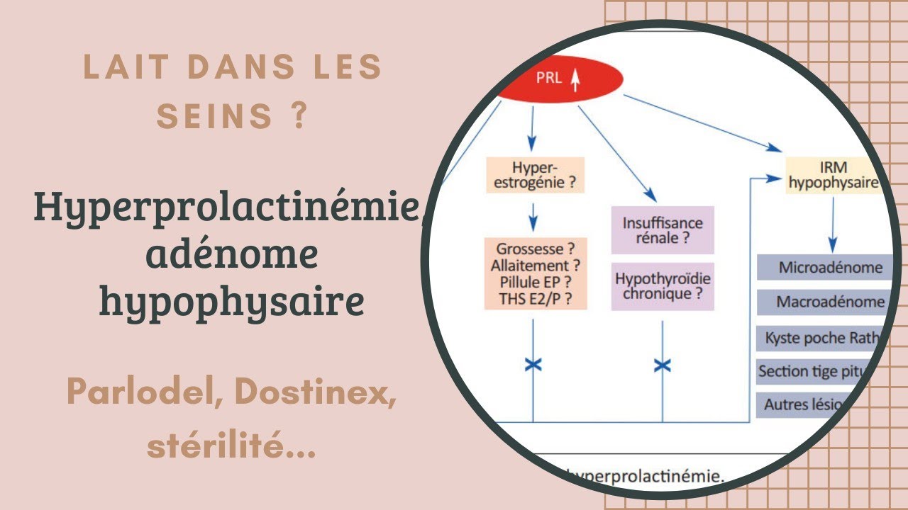 Lait dans les seins, hyperprolactinémie, adénome hypophysaire ...