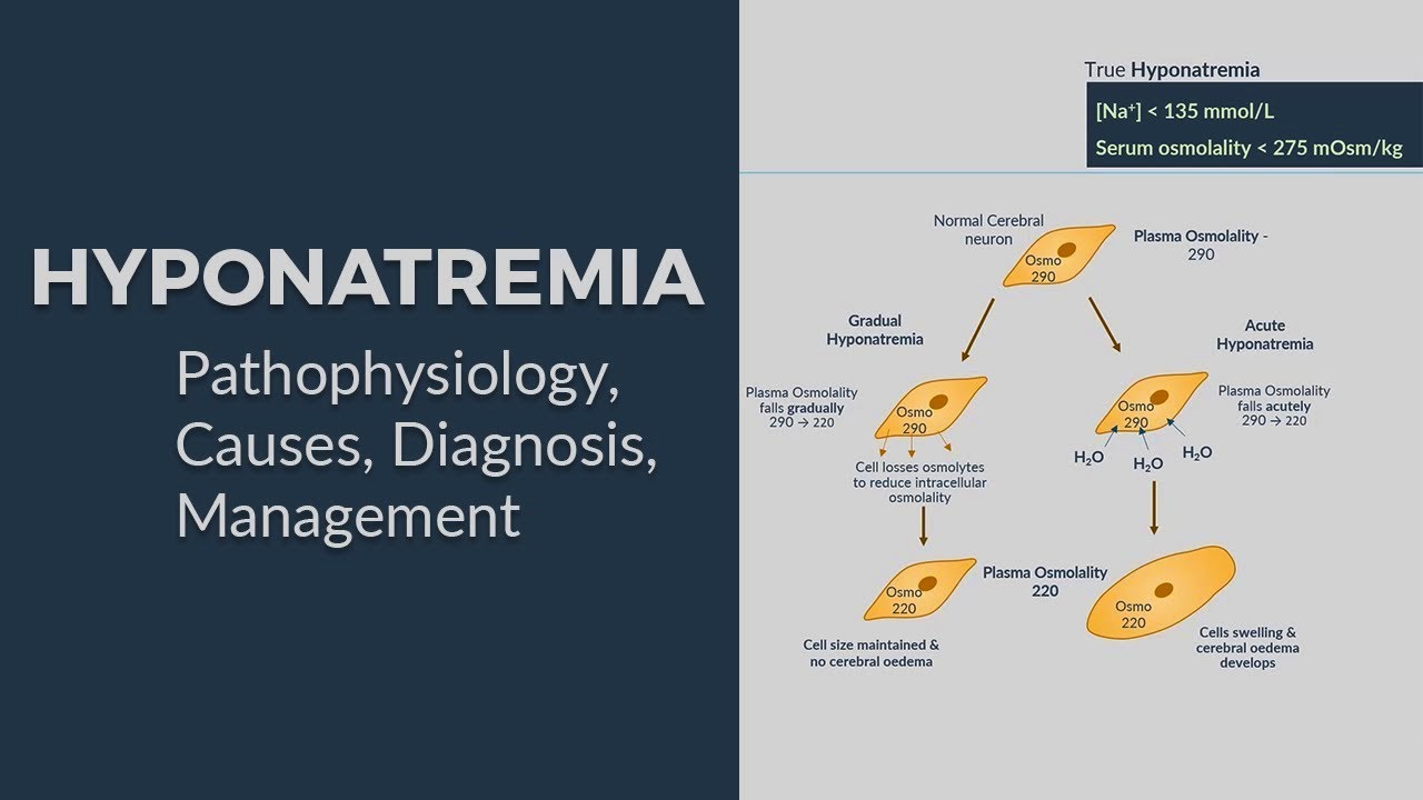 Hyponatremia Pathophysiology Causes Diagnostic Approach hyponatremia-pathophysiology-causes-diagnostic-approach